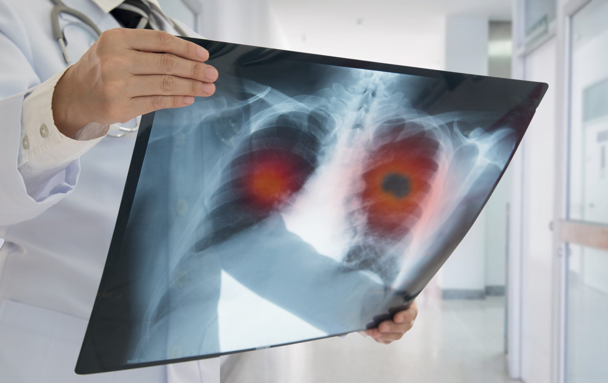 Where lung cancer patients reside may increase their risk of disease ...